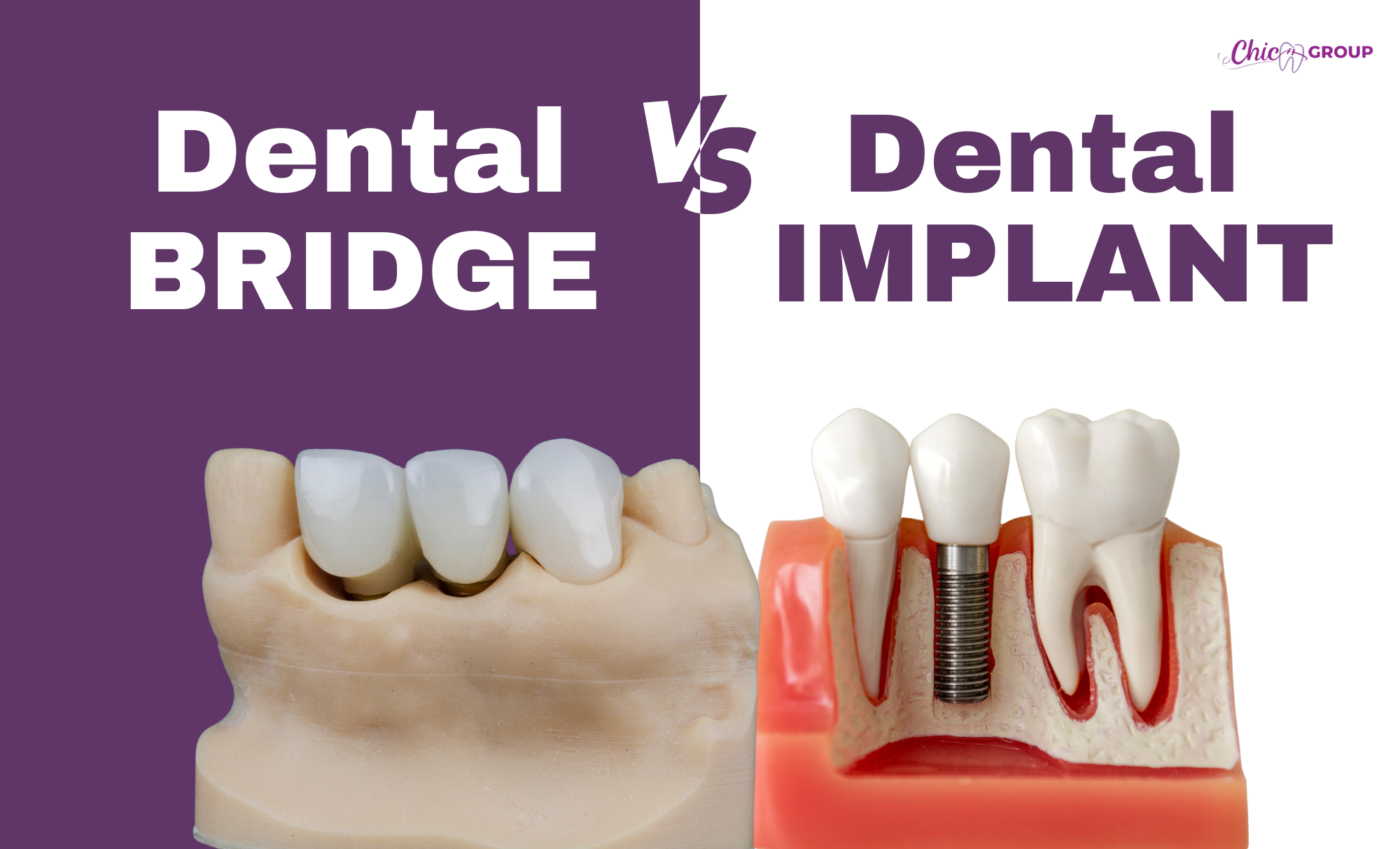 Bridge vs Implant, Mana yang Lebih Cocok untuk Menggantikan Gigi Hilang ...